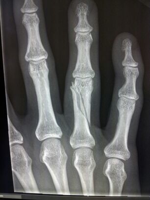 Broke my right ring finger